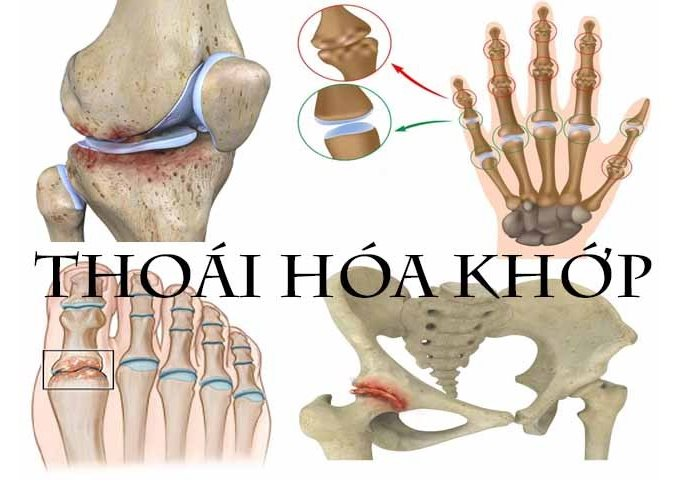 Bệnh thoái hoá khớp - dấu hiệu và cách điều trị